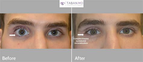 Orbital Fracture And Eyelid Laceration Surgery Enophthalmos Sunken