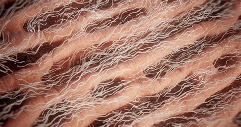 Heart Tissue Affected By Amyloid Light Chain Amyloidosis Illustration