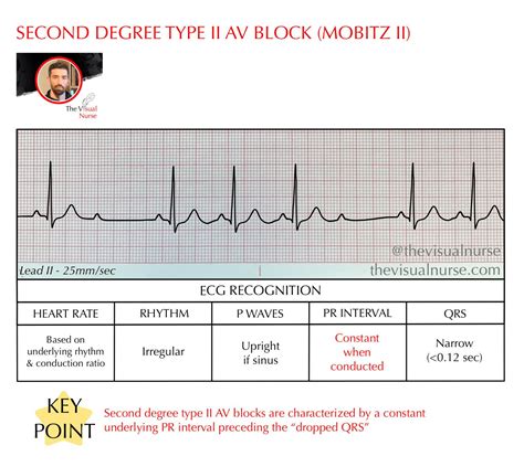 Second Degree Type Ii Mobitz Ii On The Ecg For Nurses And Nursing