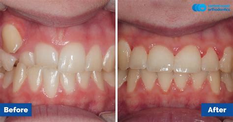 Braces At Gosford Central Coast Orthodontics