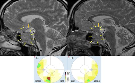 Giant Macroprolactinoma Reversible Visual Loss With Medical Therapy