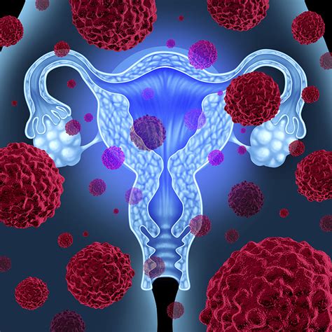 Ovarian Cancer Test To Double Detection Rates Of Silent Killer