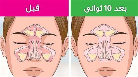 علاج انسداد الانف والتهاب الجيوب الانفية فى 10 ثوانى فقط الجزء الثانى