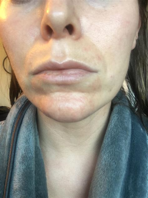 Cystic Acne On Chin 9 Months After Stopping Yasmin General Acne