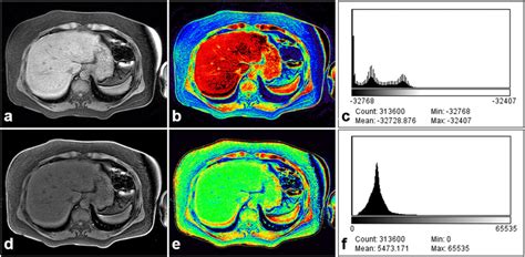 an example showing the bias correction of signal inhomogeneity based on
