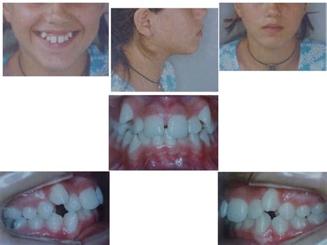 Apinhamento Com Vedamento Labial
