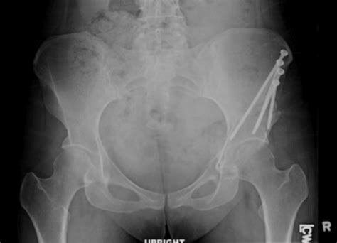 Periacetabular Osteotomy In The Setting Of Borderline Hip Dysplasia