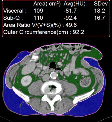 Quantification Of The Visceral And Subcutaneous Fat The Green And Blue
