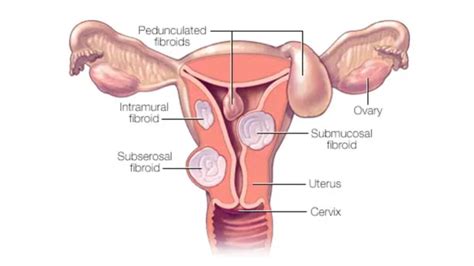 Difference Between Fibroids And Cysts Vascular Health