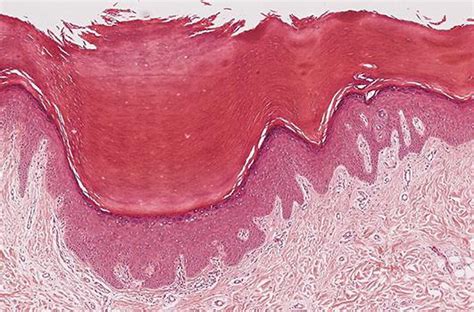 Unilateral Linear Punctate Palmoplantar Keratoderma A Case Report Pmc