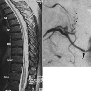 Left Sagittal Fast Spin Echo T Weighted Magnetic Resonance Image