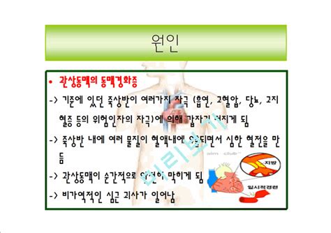 의학약학 해부생리학 심근경색 Myocardial Infarction 에 대해의약보건레포트