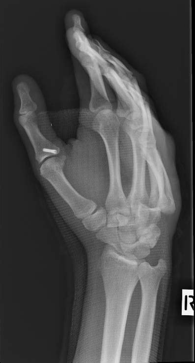 Carpo Metacarpal Dislocation The Emergency Physio