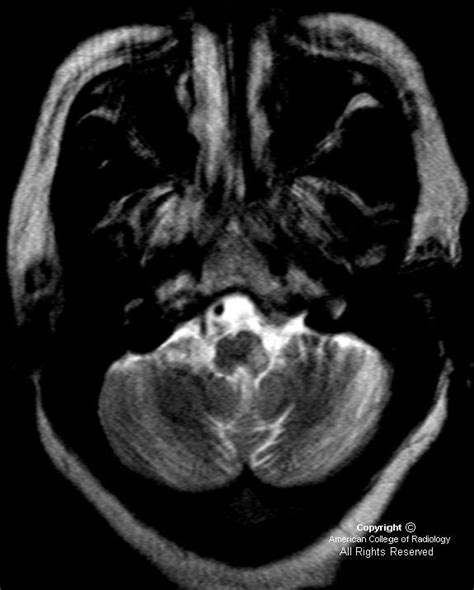 Neuroradiology On The Net Lateral Medullary Syndrome Wallenberg Syndrome