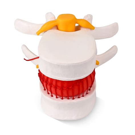Mua Human Lumbar Disc Herniation Model Vertebral Spine Anatomical