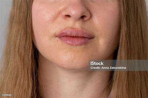 필러로 입술 확대 시술 후 여성 입술 클로즈업 뷰를 밀고 입술 히알루 론산 바늘 주사 자국의 가시적 인 장소 미용 시술 후 붓기 화장품 큰 입술 윤곽 플라스틱 30 34세에