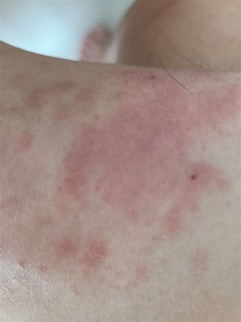 피부 두드러기 알레르기 발진 가려움 확장 지식in