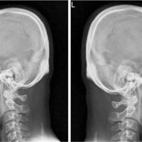 Tc 99m Mdp Bone Scan Increased Tracer Uptake In The Mandible Right Download Scientific