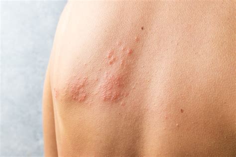 Schinken Lee Spezialist gürtelrose augen jucken Stören Psychologisch Platte