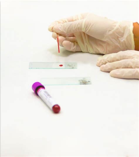 Tsh Test With T3 And T4 Hormone Evaluation