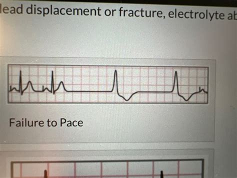 Pacemaker Malfunctions Flashcards Quizlet