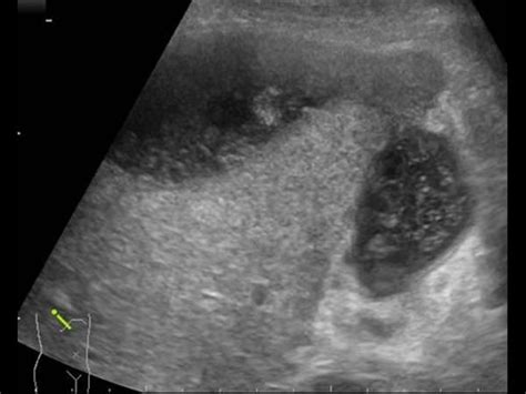 Abdomen And Retroperitoneum 12 Gallbladder And Bile Ducts Case 12
