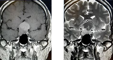 The Less Common Presentation Of Pituitary Apoplexy And Its Management