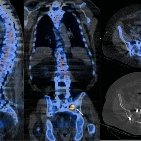 Facet Arthropathy Arrowhead Demonstrated On Radiograph A Computed