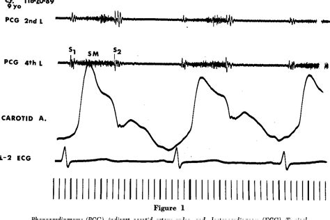 Figure 1 From Auscultatory Recognition Of Aneurysm Of The Membranous