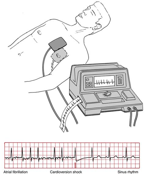 Supraventricular Arrhythmias Part Ii Atrial Flutter And Atrial Fibrillation Thoracic Key