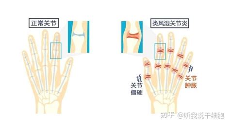 干细胞治疗类风湿性关节炎效果怎么样 知乎