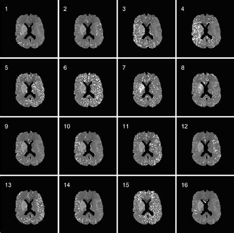 Figure 1 From Analysis Of Dynamic Susceptibility Contrast Mri Time Series Based On Unsupervised