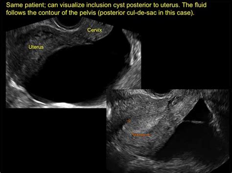 Cogwheel” And Other Signs Of Hydrosalpinx And Pelvic Inclusion Cysts
