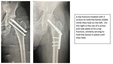 Replacement Surgery For Hip Fractures Aahks