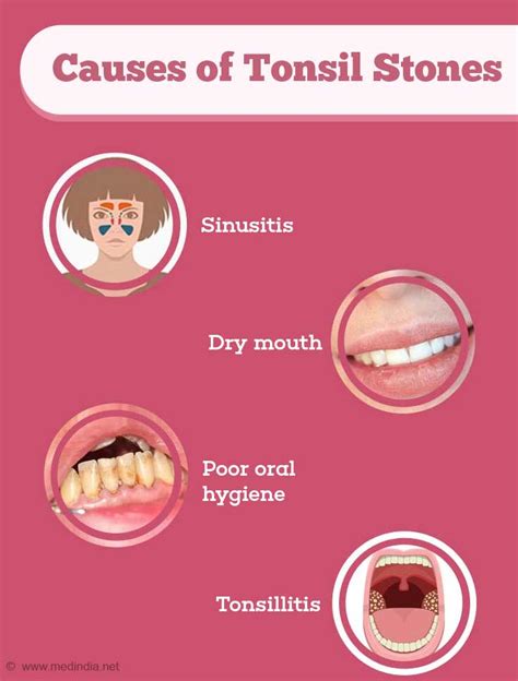 Effects Of Tonsil Stones ~ Tonsil Stones Removal Tips