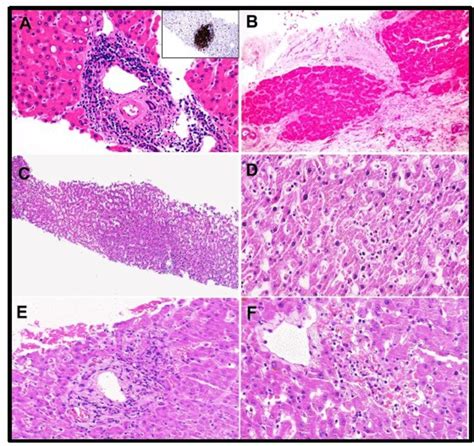 Histopathological Observations In COVID 19 A Systematic Review Journal Of Clinical Pathology