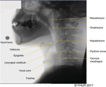 Pyriform Sinus Residue