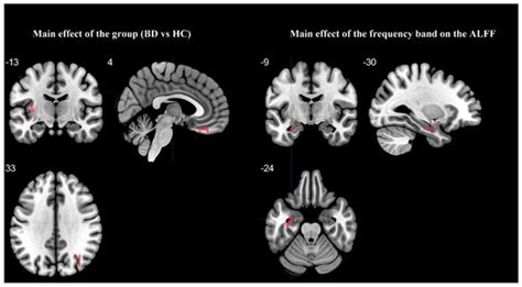 Bipolar Brain Scan Bipolar Disorders In Teenagers