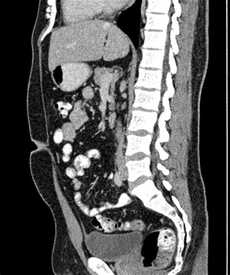 Congenital Urachal Anomalies Pacs