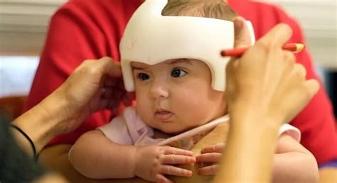 ۱۰ بیماری نادر دیگر تایید شد؛ از سندرم آنجلمن تا بدشکلی جمجمه نوزاد