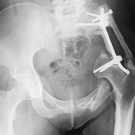 Pelvis X Rays Showing Left Iliac Wing Reconstruction With Tibial