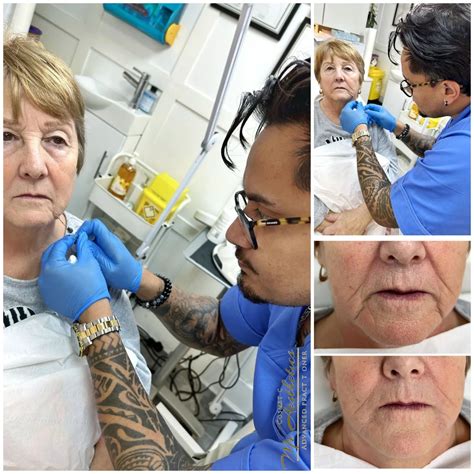 Advanced Dermal Fillers Prestige Academy