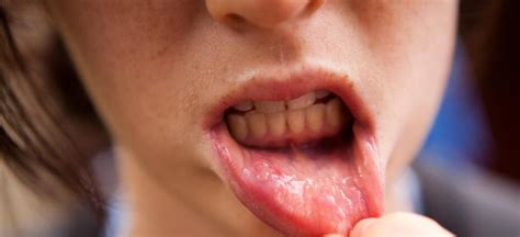 Lip Cancer Photos Cancerwalls