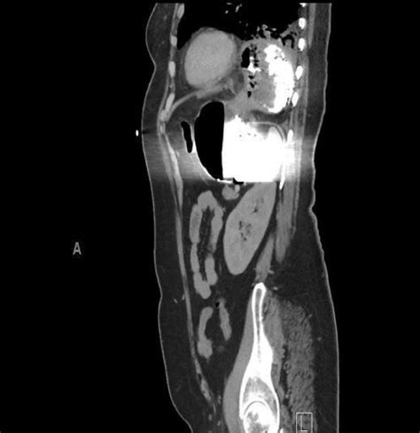 X Ray Image Of Left Hemithorax Download Scientific Diagram