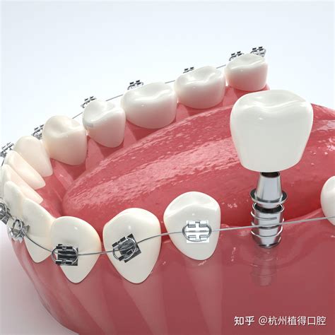 活动假牙、固定义齿和种植牙到底该怎么选？ 知乎