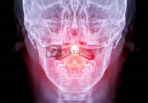 X Ray C Spine Or X Ray Image Of Cervical Spine Open Mount View For Fracture Of Cervical Vertebra