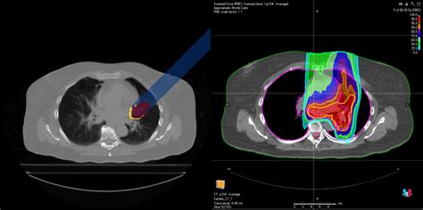 GitHub FotiouK Tailoring Proton Therapy For Lung Cancer A New