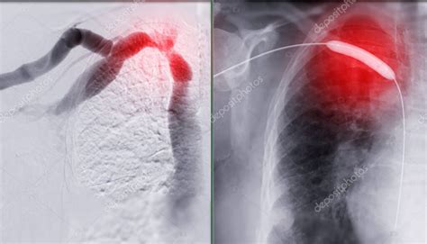 La Angioplastia Con Balón Es Un Procedimiento Médico Que Se Usa Para