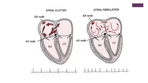 10 Ecg Interpret Topic 10 Pptx