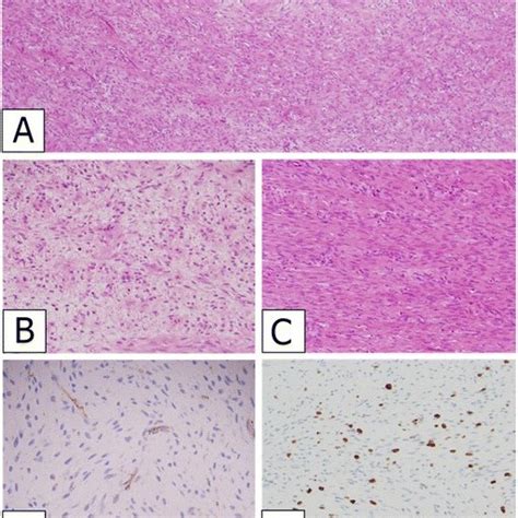 Tumor Histology An Admixture Of Myxoid And Fibrous Areas Was Observed